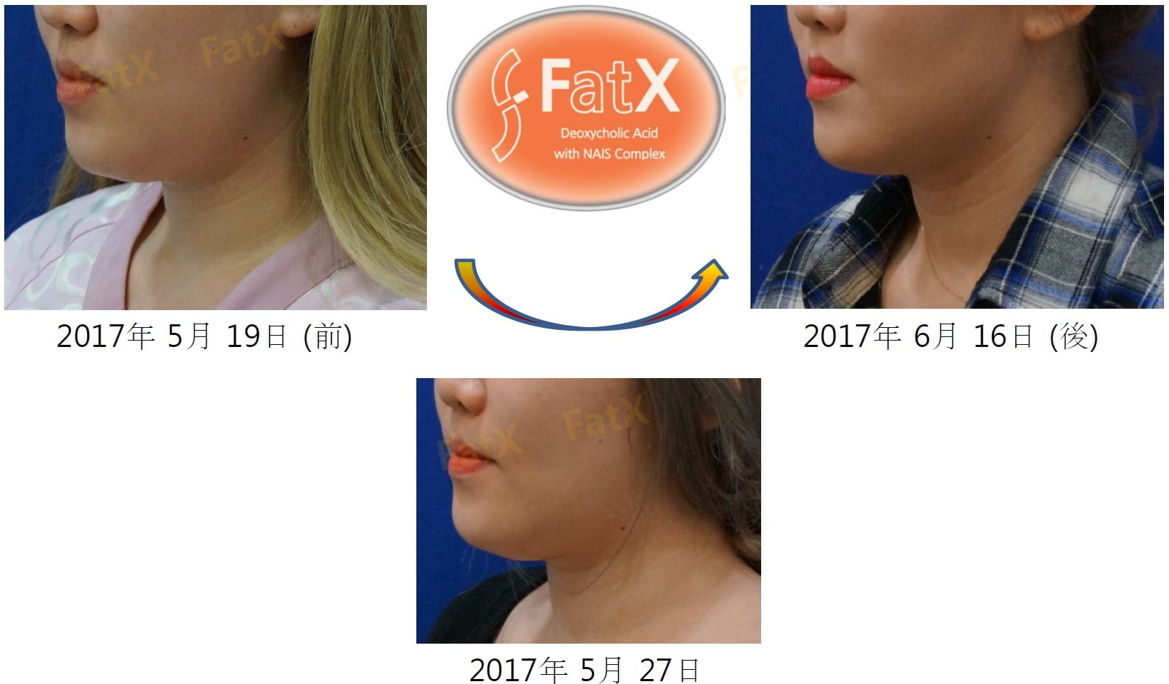 埼玉・大宮で脂肪溶解注射★FATX Core、FatXSILUETA★リバウンド抑制×たるみ予防｜いしだ美容皮膚科 | いしだ皮フ科/美容皮膚科（毎週水曜日・祝日 予約制）